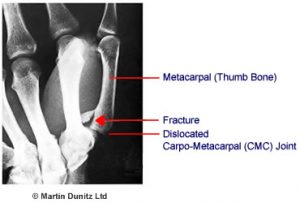 Bennett's Fracture | Dislocation of the Thumb | PhysioRoom Injury Advice
