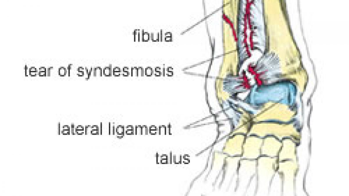 High Ankle Ligaments