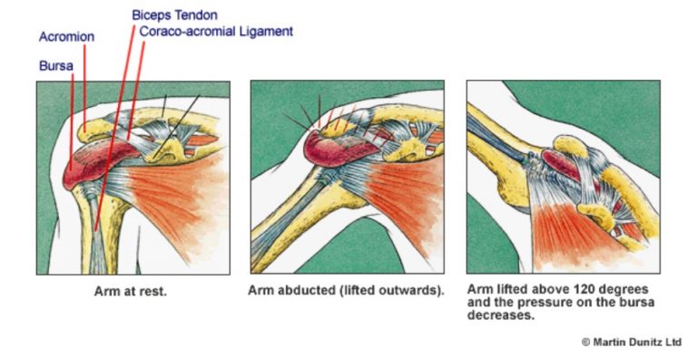 » Shoulder Bursitis Injury Treatment Guide